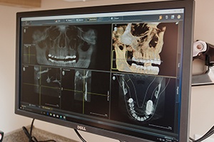 Michigan City Dental Implants | Tooth Replacements | Restorative Dentist